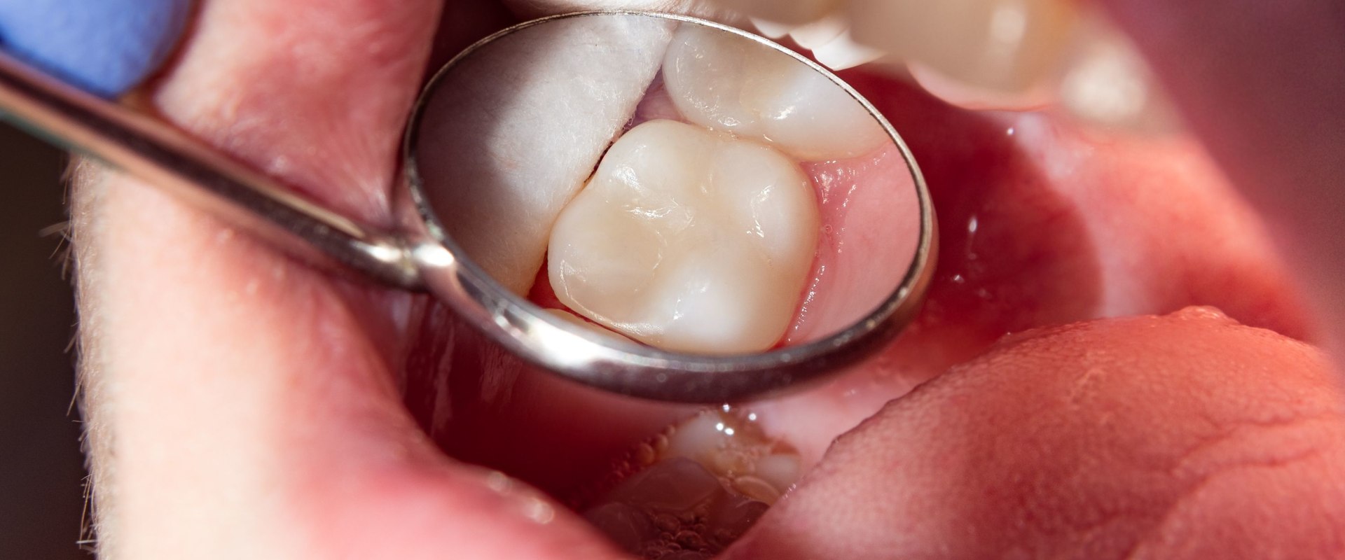 Signs and Symptoms of Filler Infections